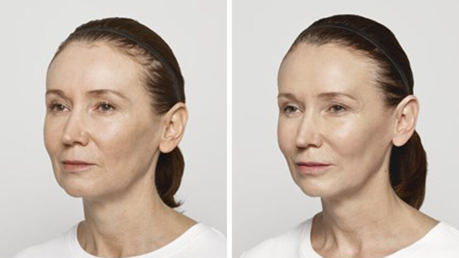 Restylane Lyft Injections | Restylane Lyft Treatments | Restylane Lyft ...