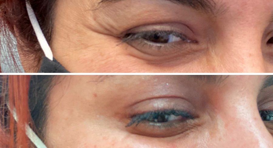 before-after-botox-crows-feet-2 - Kopelson Clinic