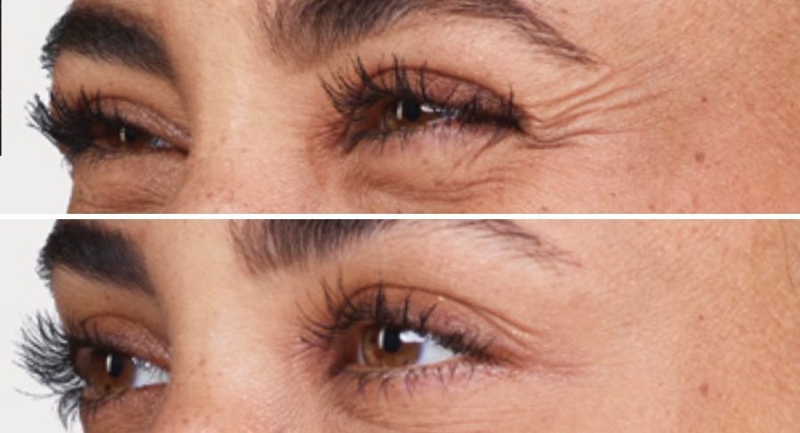 before-after-botox-crows-feet-3 - Kopelson Clinic