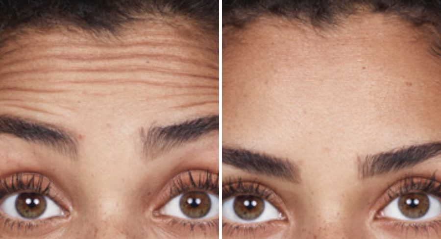 before-after-botox-forehead-wrinkles - Kopelson Clinic