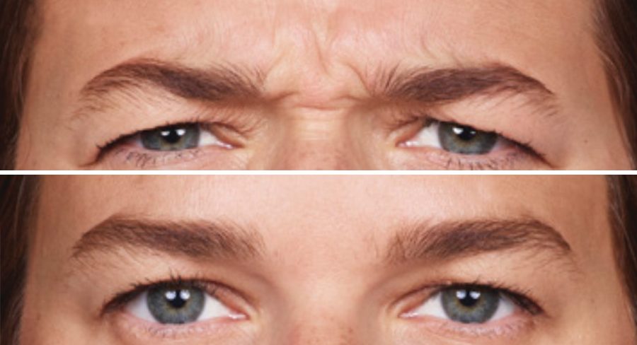 before-after-botox-frown-lines-11-lines-glabella - Kopelson Clinic