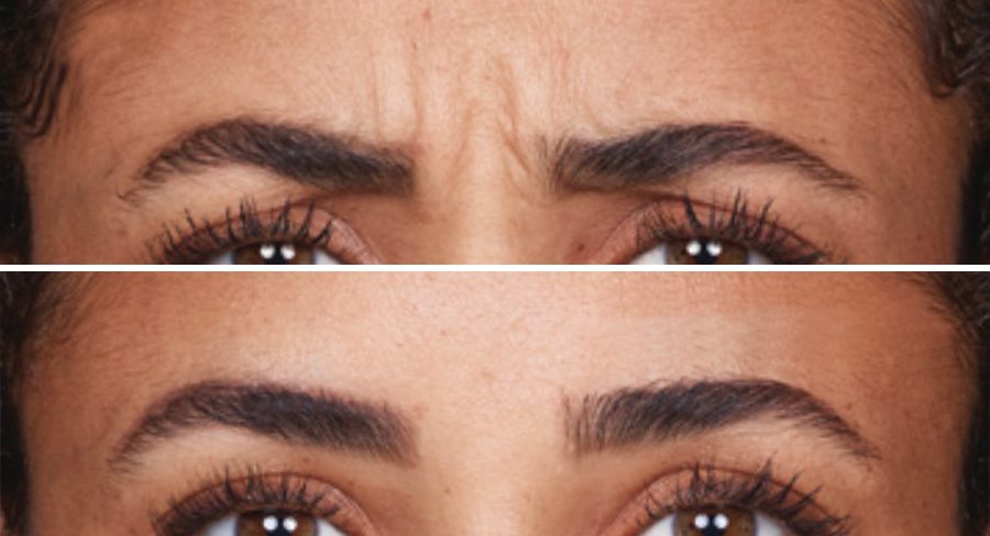 before-after-botox-frown-lines - Kopelson Clinic