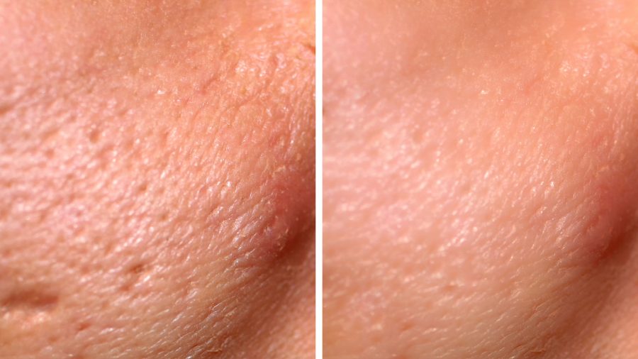 before-after-laser-uneven-tone-pore-size - Kopelson Clinic